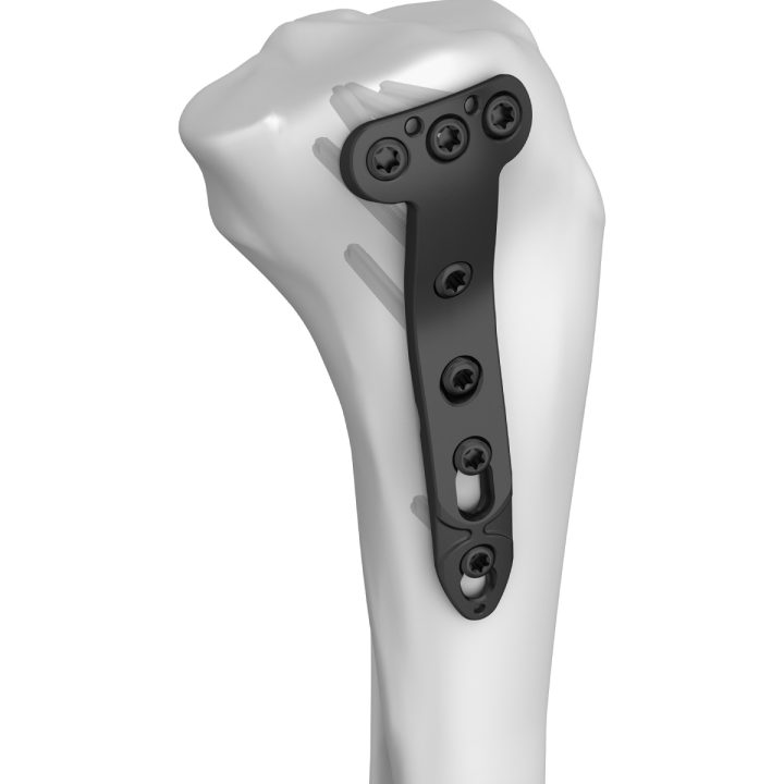 Proximal Medial Tibial T-Locking Plate | Boneunion Medical Proximal Medial Tibial T-Locking Plate | Boneunion Medical